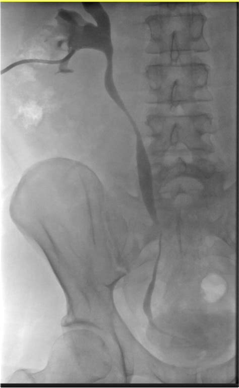 Nephrostogram Image After 7 Instillations Of Fluconazole Through The