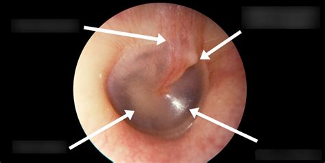 Diagram Of Tympanic Membrane Quizlet