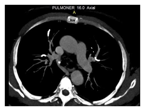 Axial View Of Thorax Ct Showing Multiple Linear Hyperdensities In