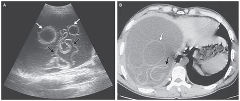 Echinococcal Cysts In The Liver Nejm