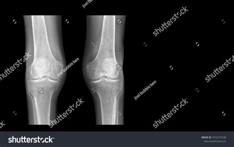 2 Calcium Pyrophosphate Dihydrate Crystal Deposition Disease Images