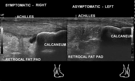 Retrocalcaneal Bursitis Mri