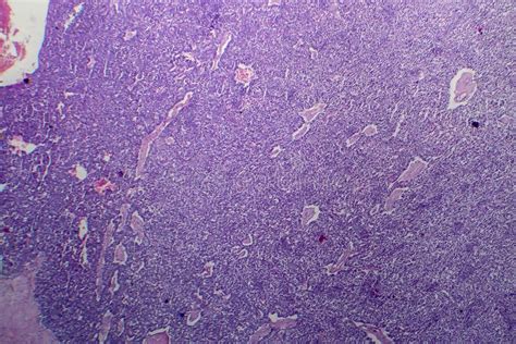 Wilms Tumor Light Micrograph Stock Image Image Of Cancer Pathology 161612985