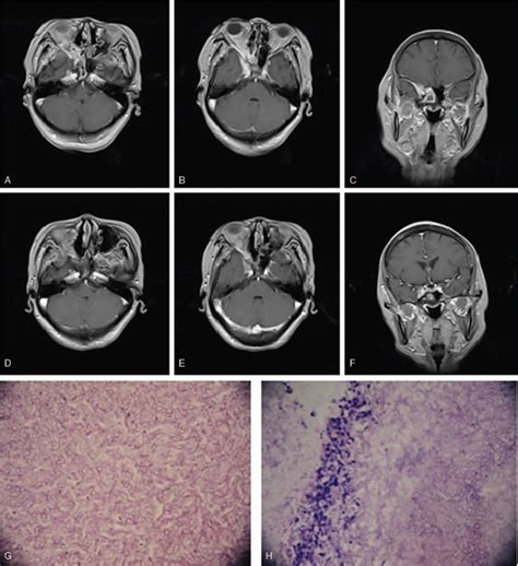 Cavernous Sinus Orbital Apex Aspergillus Infection In A Diab Medicine