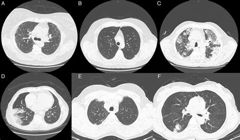 Adult Bronchiolitis A Clinical And Pathological Interpretative Classification