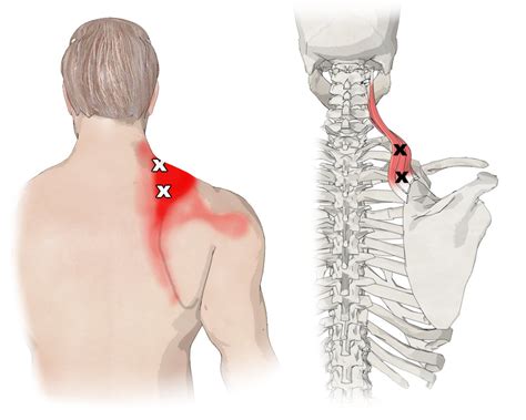 Levator Scapulae Trigger Points