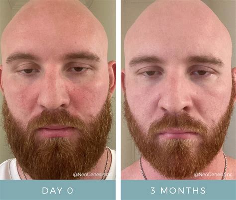 Seborrhoeic Dermatitis Face