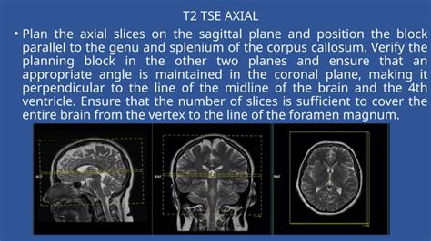 Mri Brain Protocol And Planningpptx Mri Brain Protocol And Planningpptx