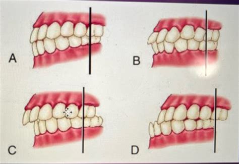 Occlusion Flashcards Quizlet