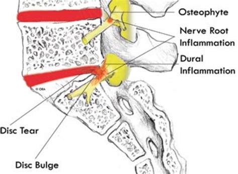 Nerve Root Block And Injection At Dr Sanjay N Patil Spine Clinic In