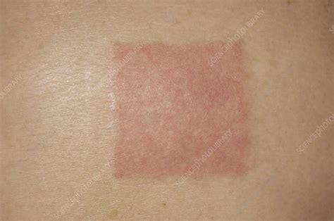Skin Irritation From Transdermal Patch Stock Image C0042407