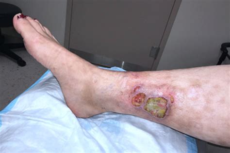 结节性多动脉炎小腿溃疡图片