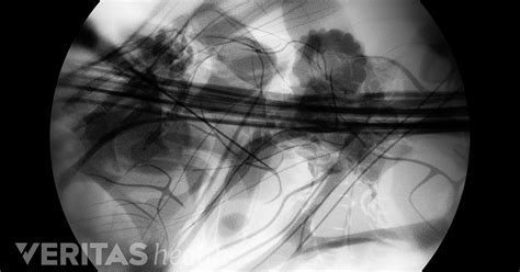 Lumbar Radiofrequency Neurotomy Video