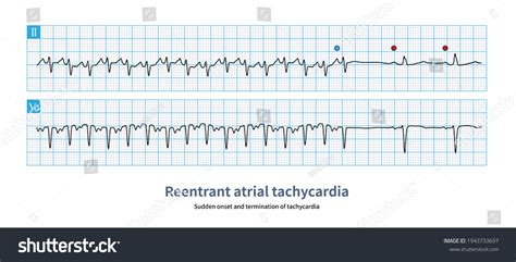 Atrial And Ventricular Ectopy