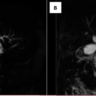 A B Magnetic Resonance Cholangiopancreatography MRCP Of The Download Scientific Diagram