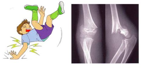 上腕骨顆上骨折（子供にみられる肘の骨折） 古東整形外科・リウマチ科