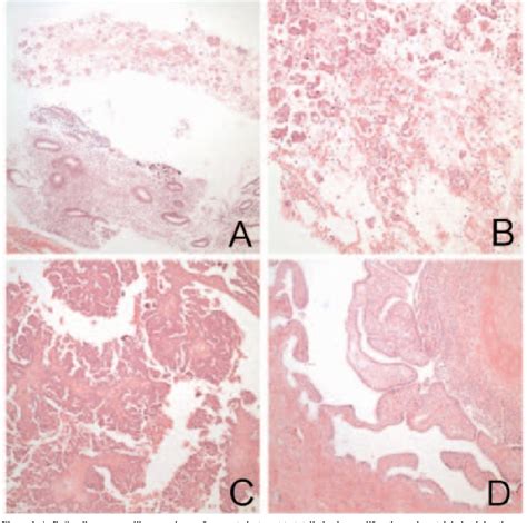 Simple Endometrial Hyperplasia Without Atypia Semantic Scholar