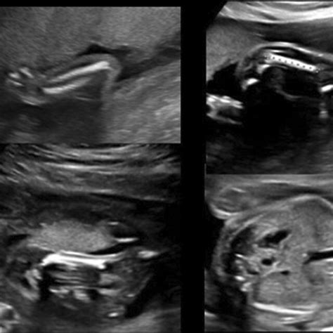Topology Map Of Fgfr3 With Major Sites Of Variant Ach Achondroplasia Download Scientific