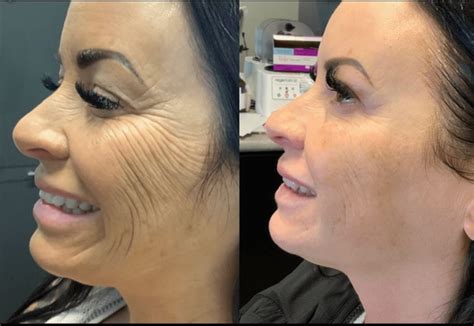Morpheus 8 Rf Microneedling Package Reflections Aesthetics And Iv Bar