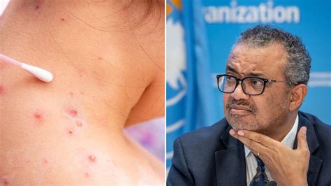 Mpox Oms Declara La Viruela Del Mono Como Nueva Emergencia De Salud