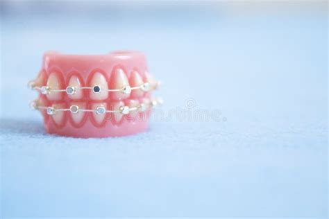 Metal Orthodontic Denture Base Stock Image Image Of Orthodontist Device 268086003