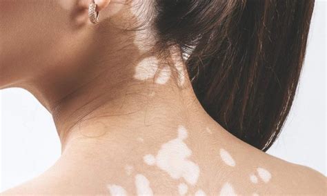 Buy Benoquin Cream Monobenzone 20 Price Uses And Dosage