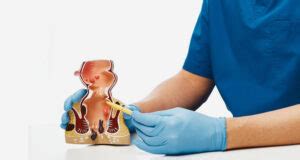 Anorectal Manometry Mission Gastro Hospital