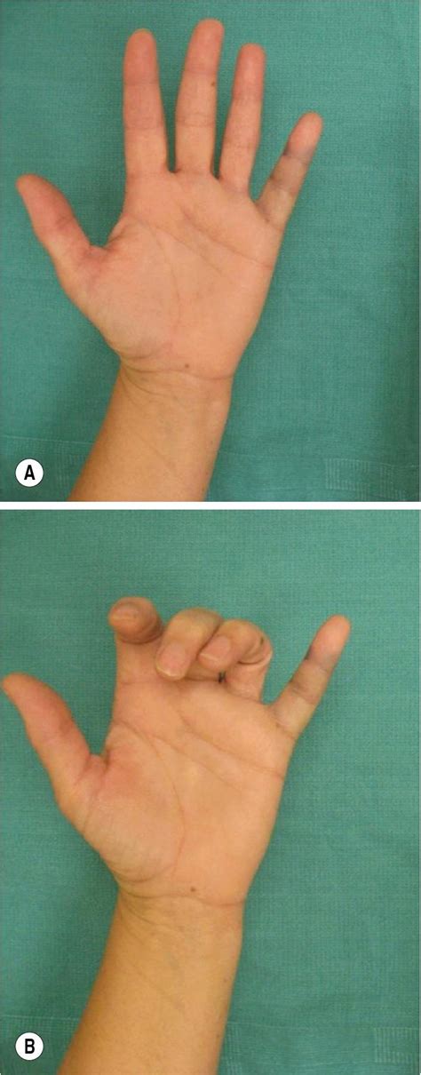 Open Reduction And Internal Fixation Of Intraarticular Phalangeal Fractures Clinical Tree