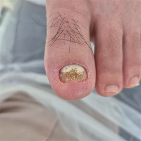 레푸스동탄호수 동탄내성발톱 동탄무좀 동탄발각질 동탄발관리 문제성발 각질이 쌓이고 갈라진 발뒤꿈치에 풋크림을 아무리 열심히