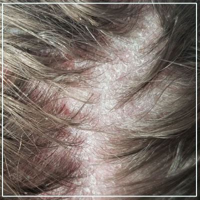 Dermatitis On Scalp