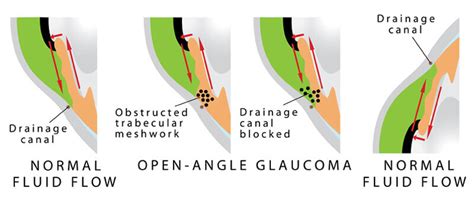 Types Of Glaucoma Ophthalmic Consultants Of Vermont