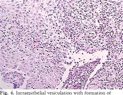 Figure 2 From Pyostomatitis Vegetans Report Of A Rare Case Semantic Scholar