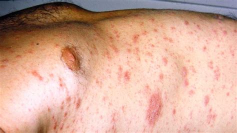 Red Circle On The Skin But Not Ringworm Other Causes
