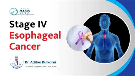 Stage Iv Esophageal Cancer Dr Aditya Kulkarni