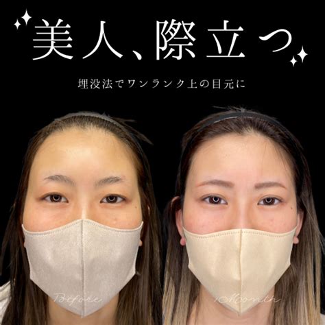自然癒着法 20代 女性 吉田dr あいちビューティークリニック｜愛知・jr「安城」駅徒歩1分の美容皮膚科・美容外科