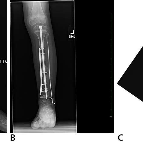 Paley Classification Of Congenital Pseudarthrosis Of The Tibia Type 1 Download Scientific