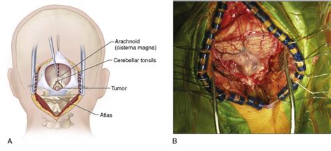 Suboccipital Craniotomy Neupsy Key