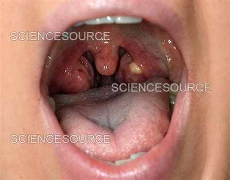 Tonsil Cyst Stock Image Science Source Images