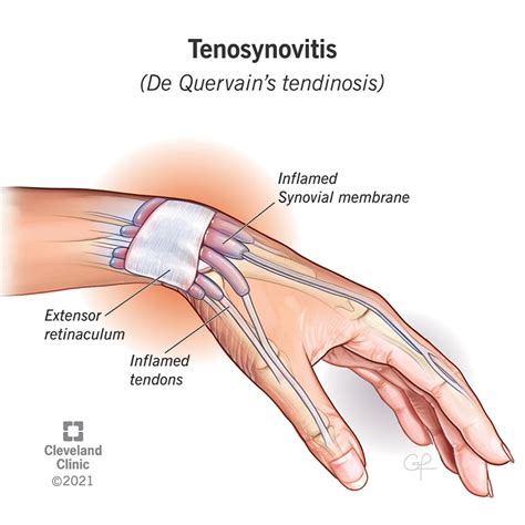 Infectious Flexor Tenosynovitis