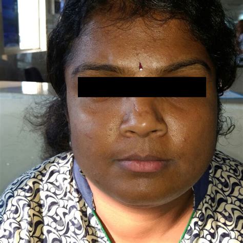 Clinical Picture Showing Diffuse Swelling Of The Face Download Scientific Diagram