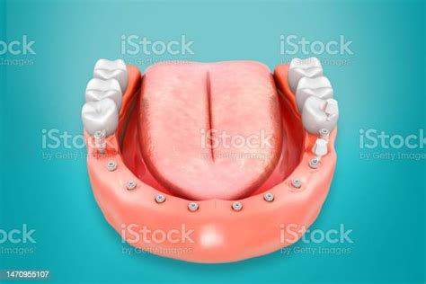 치아 임플란트 건강한 치아 및 치과 임플란트 3d 그림 임플란트에 대한 스톡 사진 및 기타 이미지 임플란트 치아 건강 3차원 형태 Istock