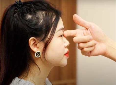 Review Cận Cảnh 1 Ca Nâng Mũi Bằng Sụn Sinh Học Vỏn Vẹn Trong 45 Phút