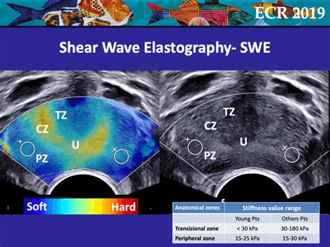 The Swe Map Allows The Different Prostatic Zones To Be Distinguished The Swe Map Allows The Different Prostatic Zones To Be Distinguished
