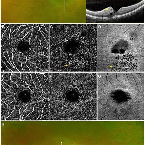 Macular Capillary Abnormalities In Eye With Macular Edema A 9 Years