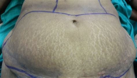 Management Of Stretch Marks Striae