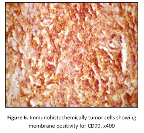 EwingÃ Æ Ã Â¢Ã â Ã¢â Â¬Ã â Ã¢â Â¢s Sarcoma Primitive Neuroectodermal Tumor Es Pnet In The Lung