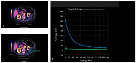 Computed Tomography Urography State Of The Art And Beyond Pmc