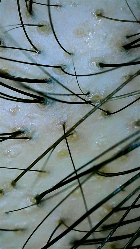 I Bought A Microscope How Does My Scalphairs Look Ive Been Suffering Diffuse Thinning And I Bought A Microscope How Does My Scalphairs Look Ive Been Suffering Diffuse Thinning And