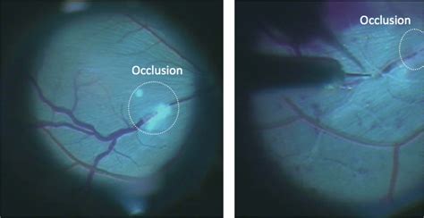 Injection Of Ocriplasmin At The Level Of A Branching Vessel Or Beyond