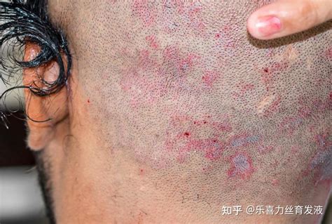 脱发能长时间戴假发吗戴假发有什么危害 知乎